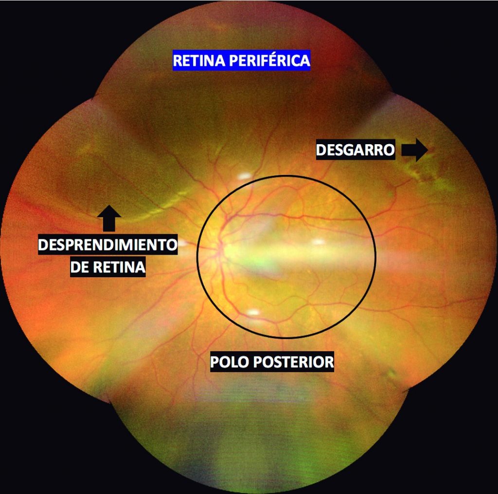 Desprendimiento de Retina - Hospital del Ojo