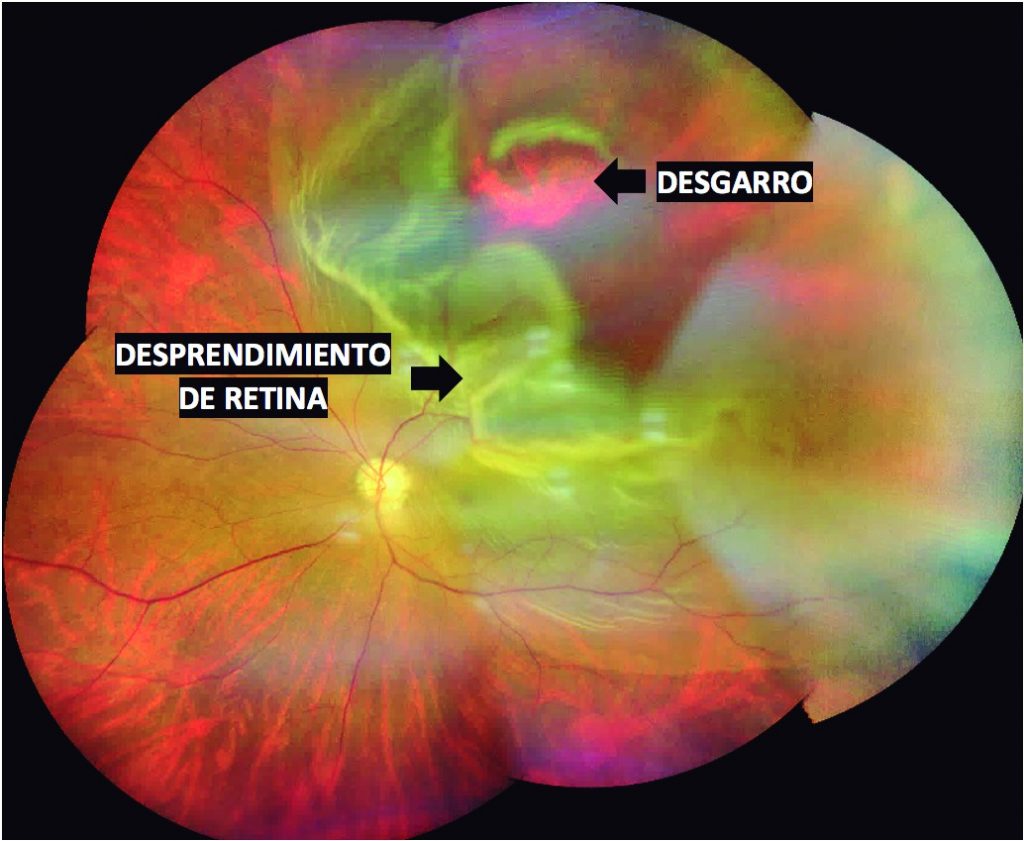 Desprendimiento de Retina - Hospital del Ojo