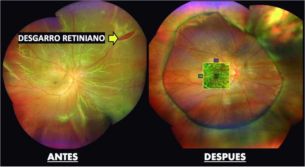 Desprendimiento de Retina - Hospital del Ojo