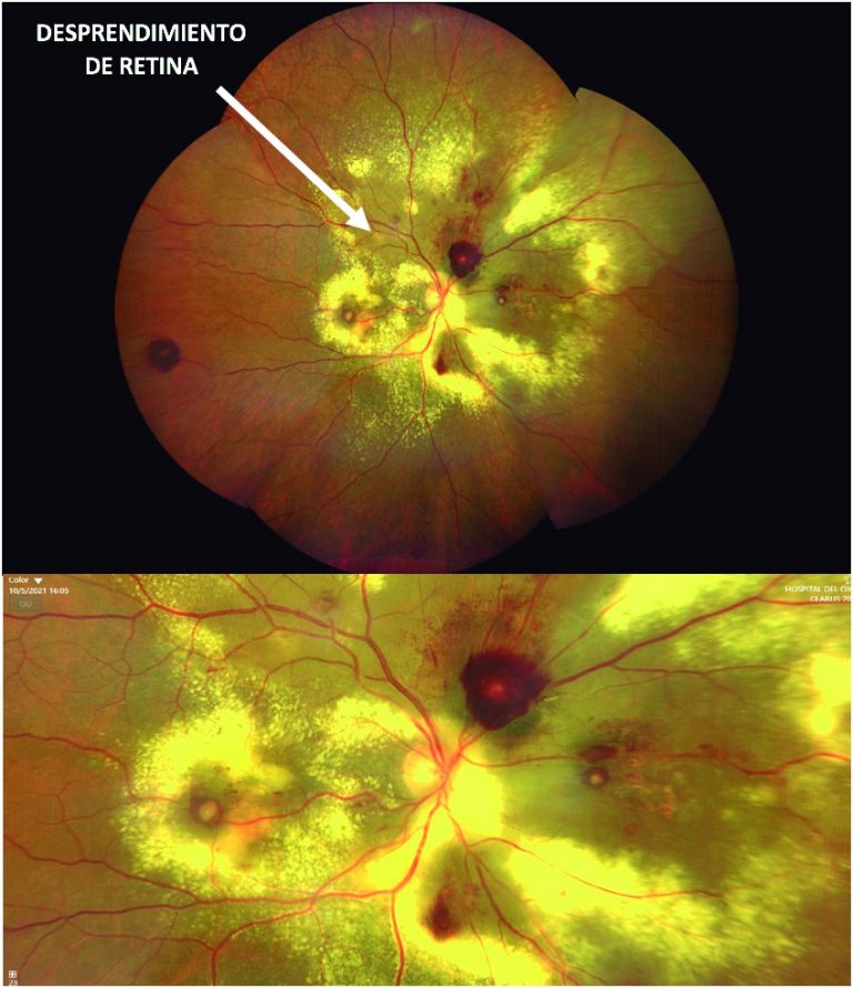 Desprendimiento de Retina - Hospital del Ojo