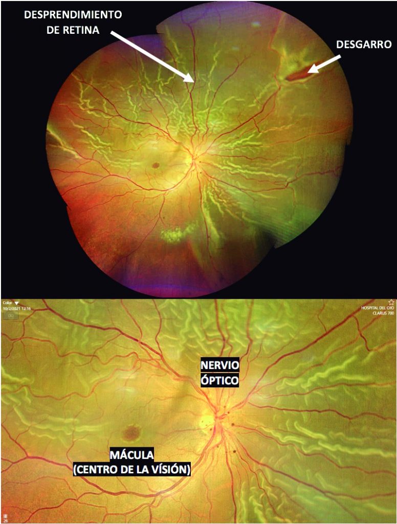 Desprendimiento de Retina - Hospital del Ojo
