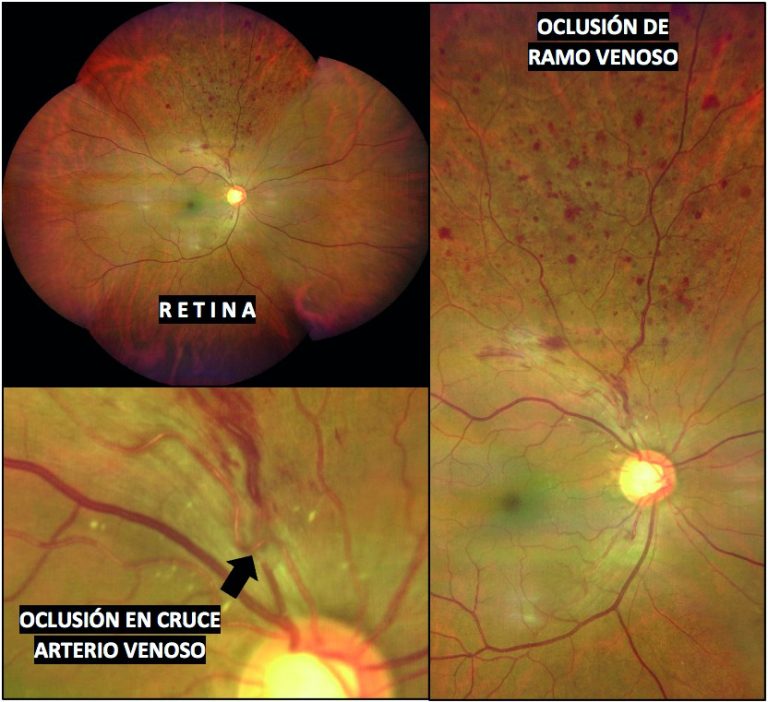 OCLUSIÓN VENOSA RETINIANA - Hospital del Ojo