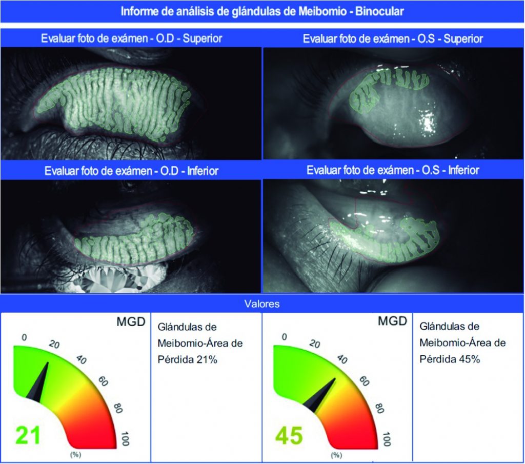 OJO SECO – Hospital del Ojo